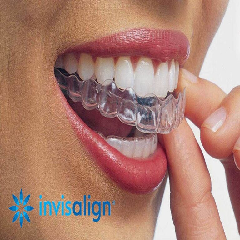 Invisalign Package – iTrade Pay Marketplace
